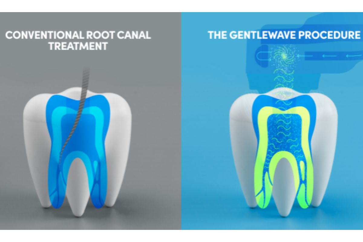 Outcomes of the GentleWave System on Root Canal Treatment