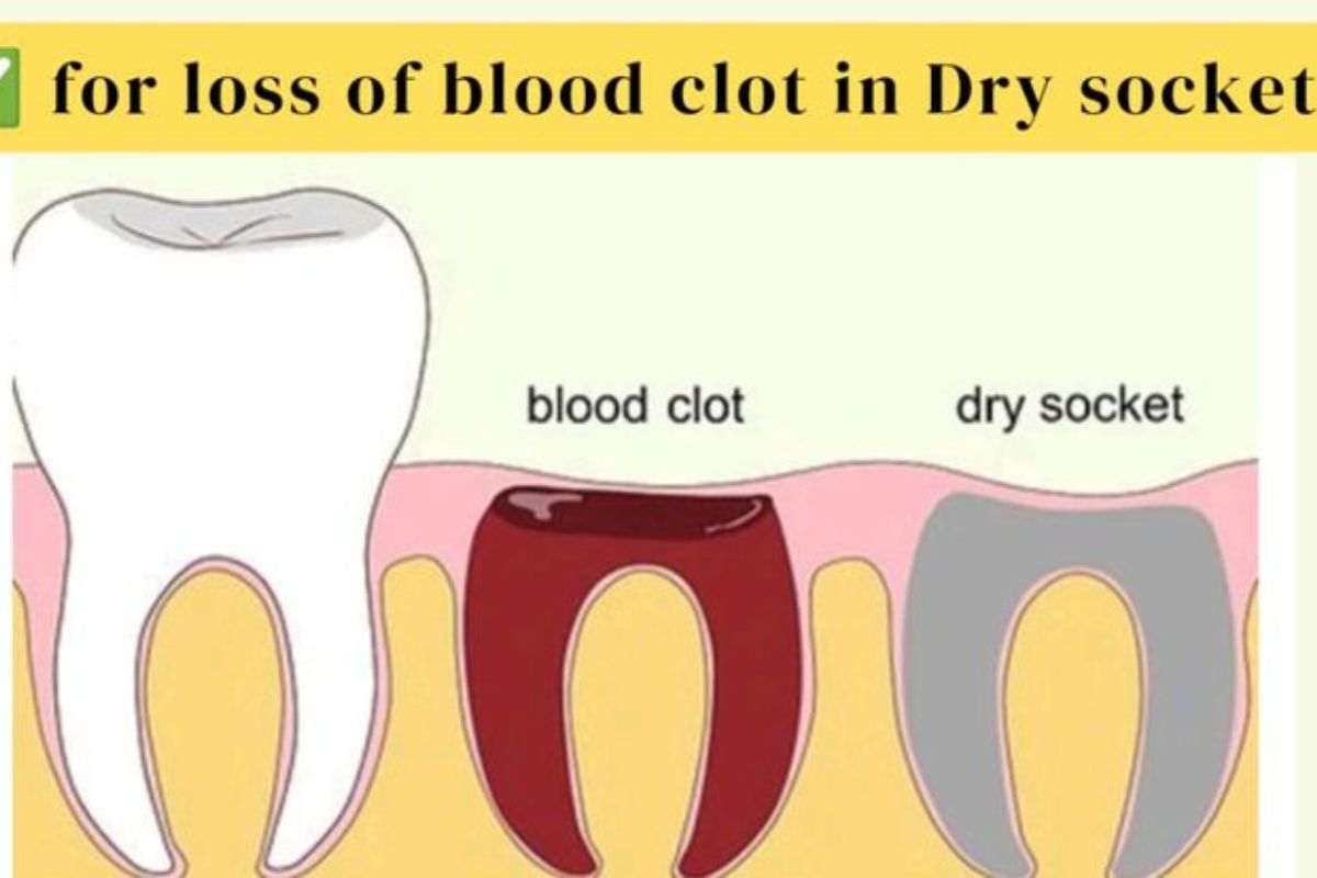 Is Dry Socket/Alveolar Osteitis an Emergency Dental Case?