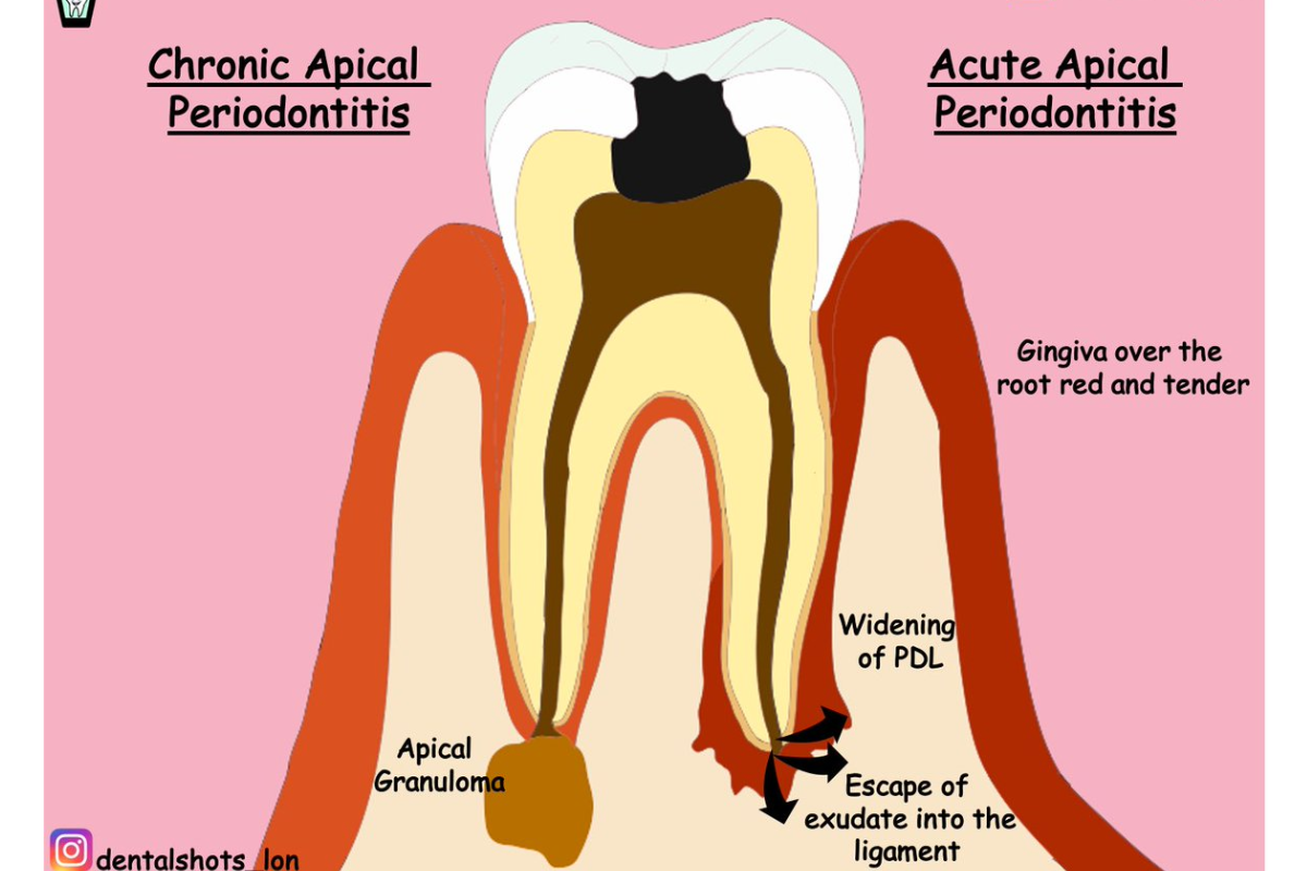 How is chronic apical periodontitis treated?
