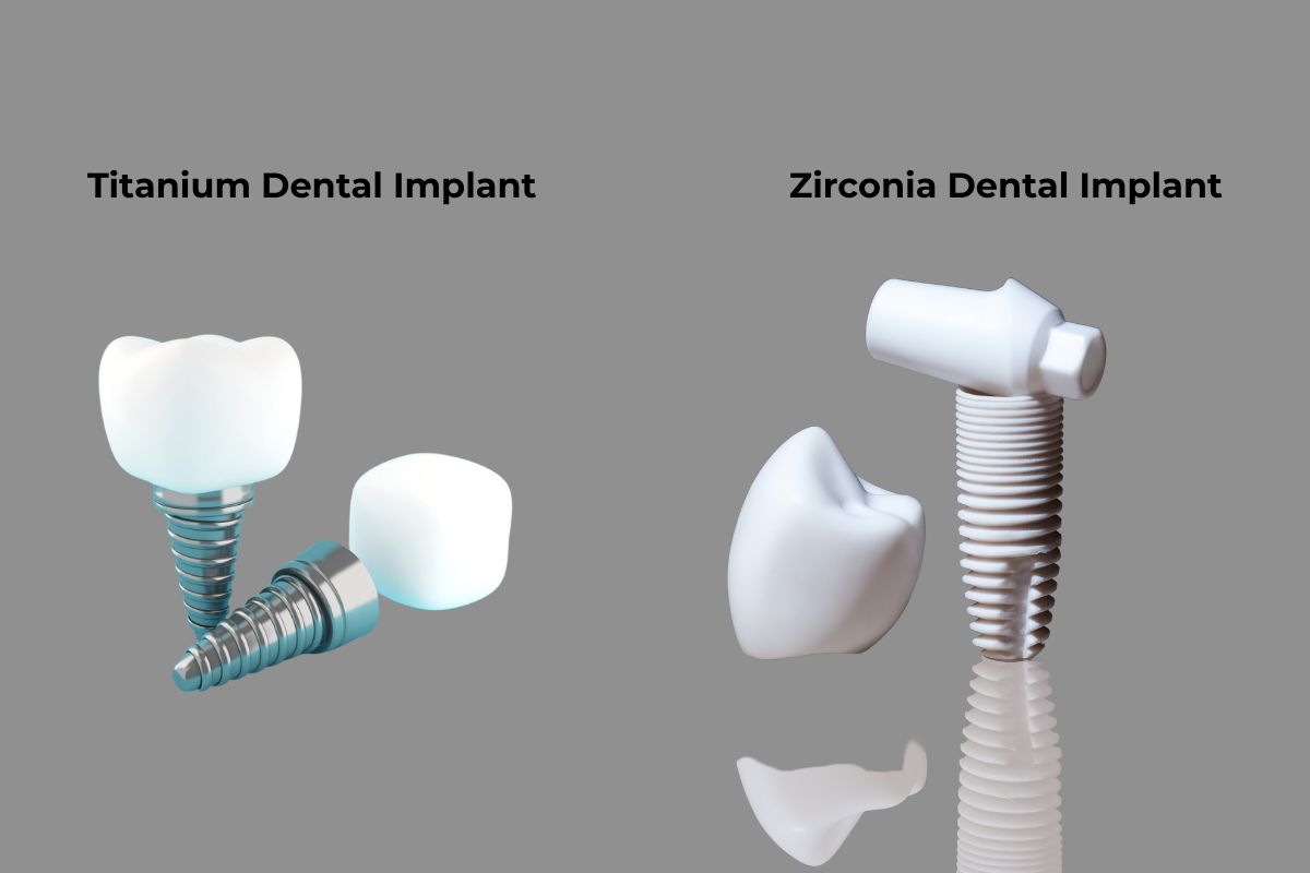 Comparing Dental Implant Materials: Titanium Vs. Zirconia