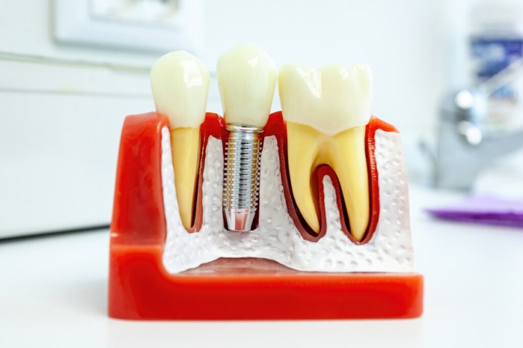Can You Get an MRI Scan with Dental Implants?