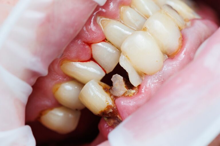 How Quickly Does Amoxicillin Work on Tooth Infections?